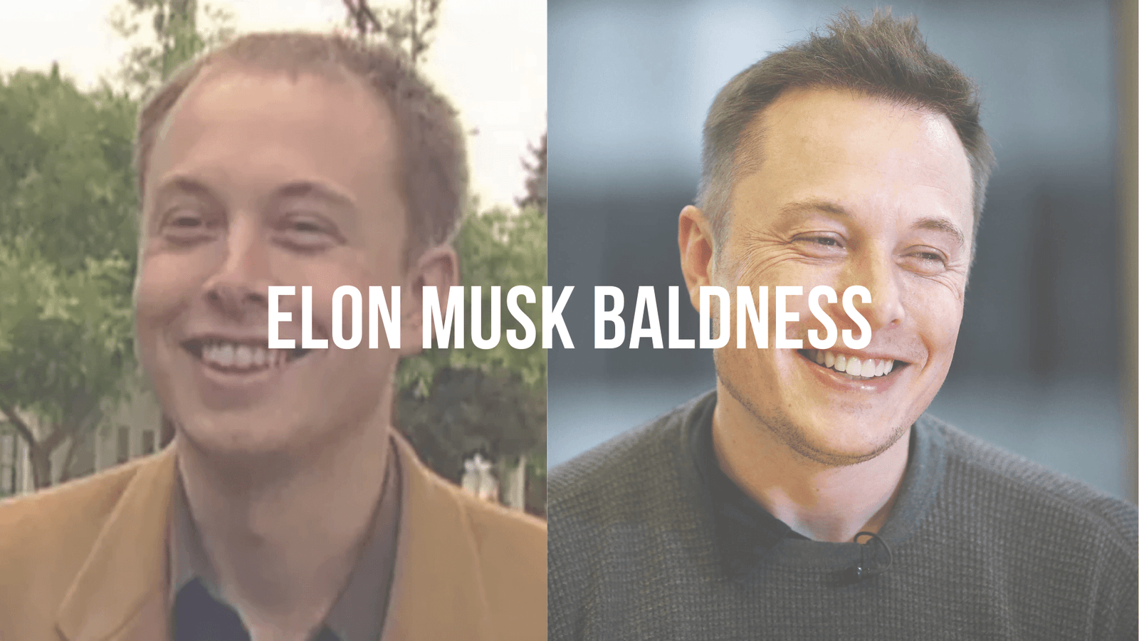 Did Elon Musk have a hair transplant? - BALD LIFESTYLE
