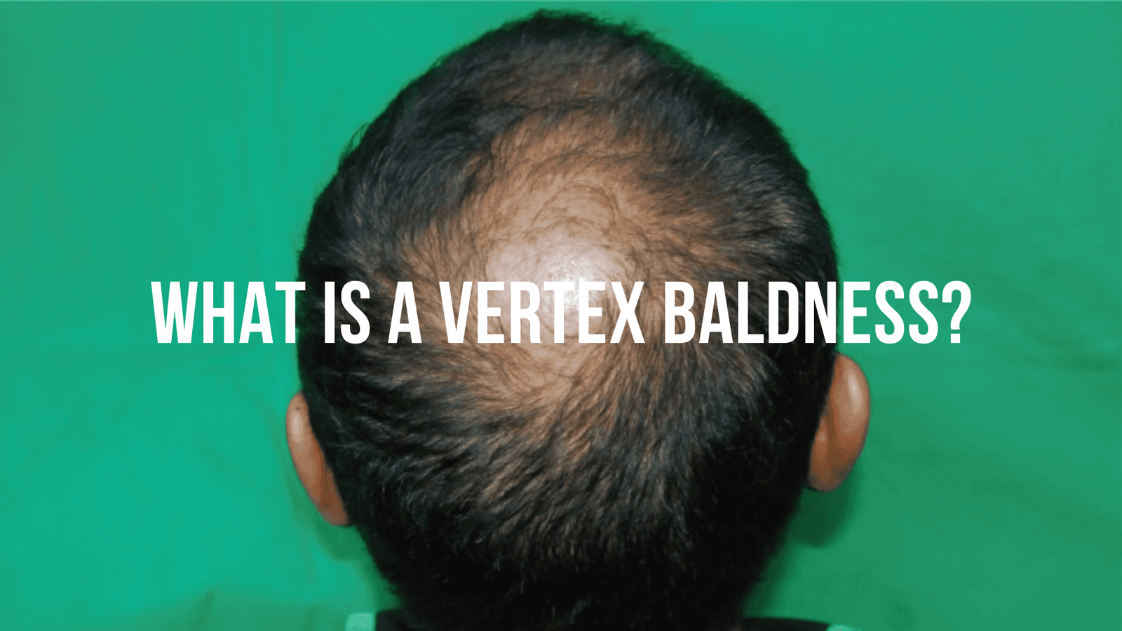 Understanding Vertex Baldness - BALD LIFESTYLE